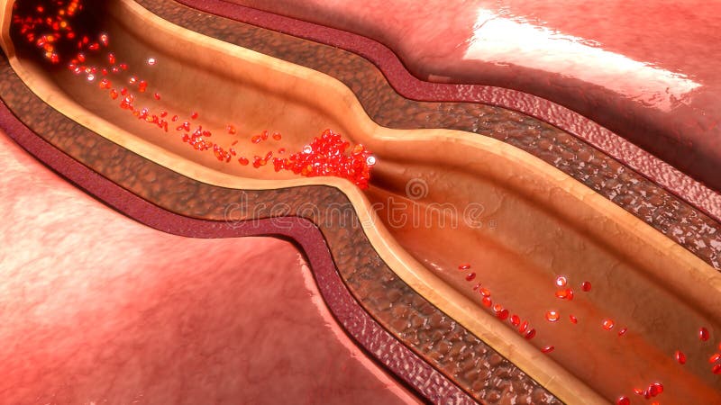Coronary artery spasm stock illustration. Illustration of medical ...