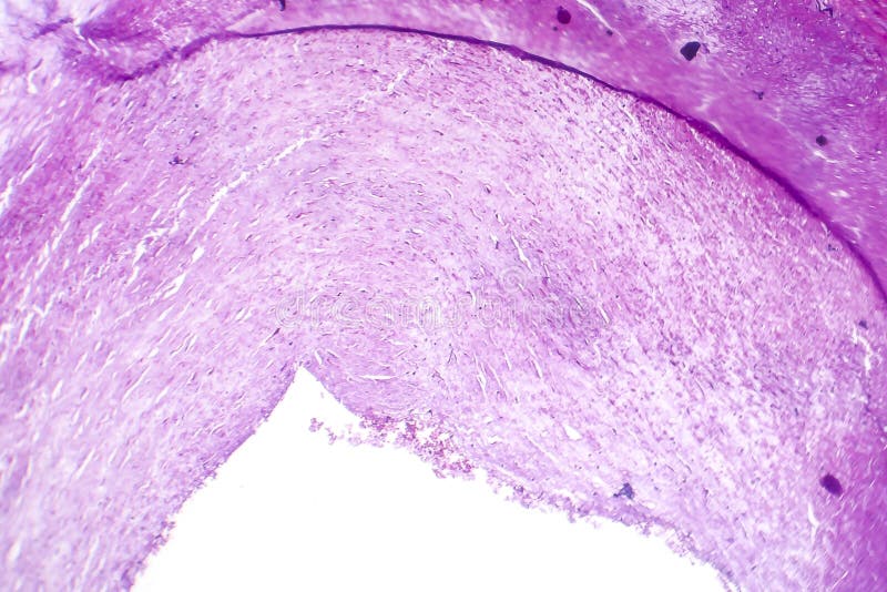 Coronary Atherosclerosis, Light Micrograph Stock Image - Image of ...