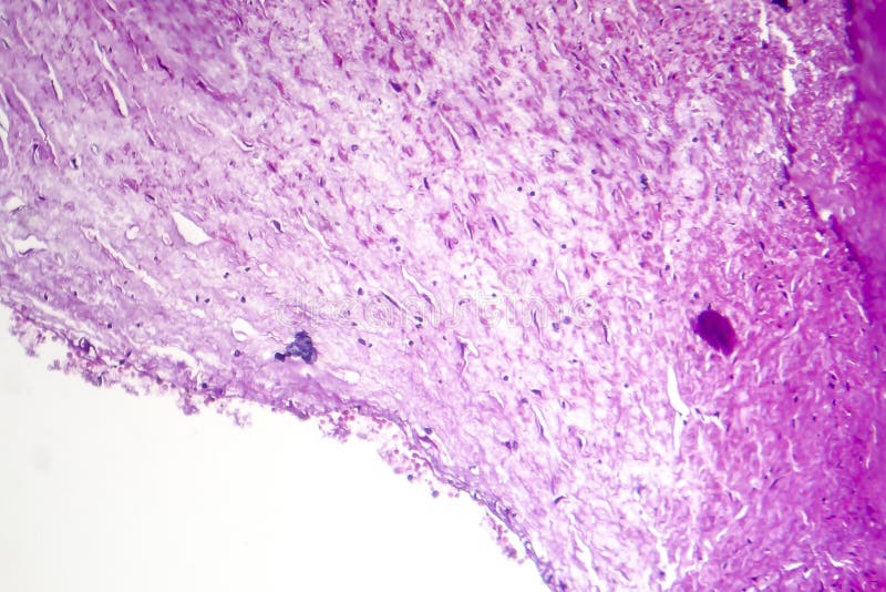 Coronary Atherosclerosis, Light Micrograph Stock Photo - Image of ...