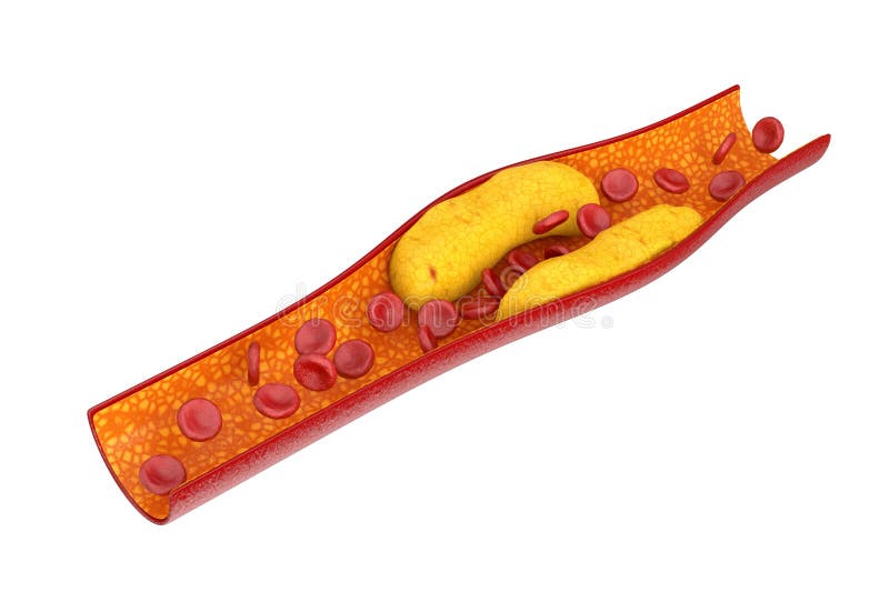 Coronary Plaque Clogget in Artery, Artery Blocked with Bad Cholesterol ...