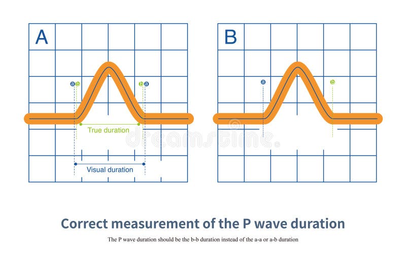 Correct Measurement of the P Wave Duration Stock Illustration ...