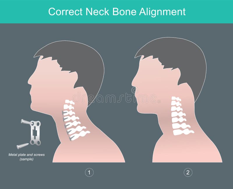 Correct Neck Bone Alignment. Stock Vector - Illustration of align ...