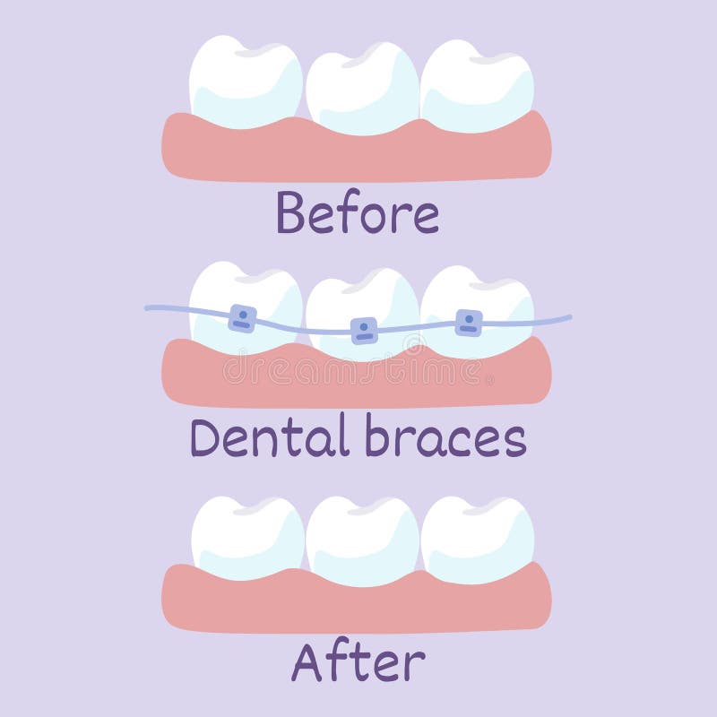 Before after Correction Brackets Vector Illustration Flat Style Stock ...
