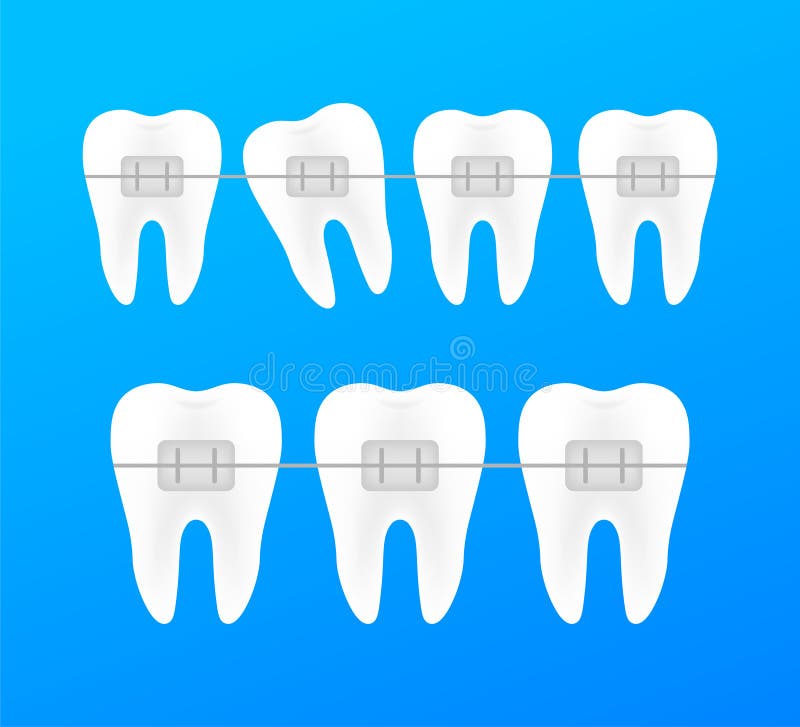 Correction of Teeth with Orthodontic Braces. Stages of Teeth Alignment ...