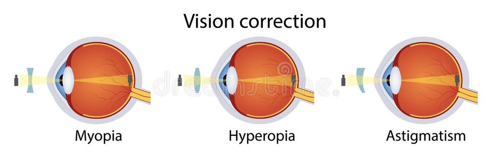 Correction of Various Eye Vision Disorders by Lens. Hyperopia, Myopia ...
