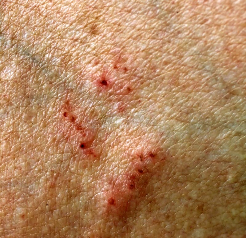 Cause Dor Da Ferida E Do Risco Com Gotas Do Sangue Na Pele Humana ...