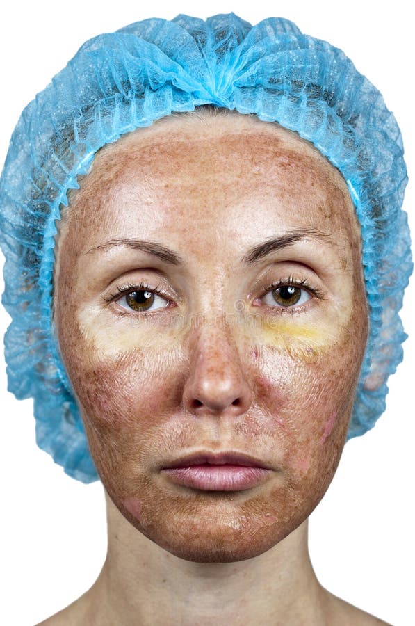 Cosmetology. Chemical Peeling. Boundary between the Processed and ...