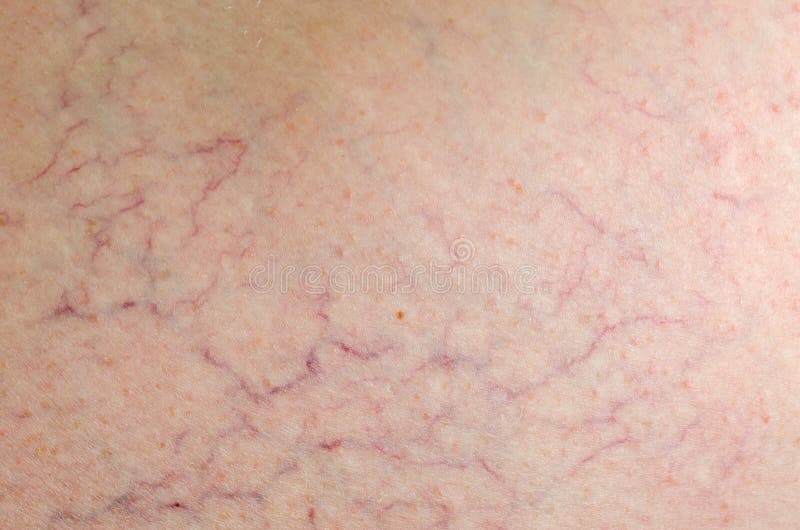 Couperosis stock photo. Image of blemishes, dermatology - 37521954