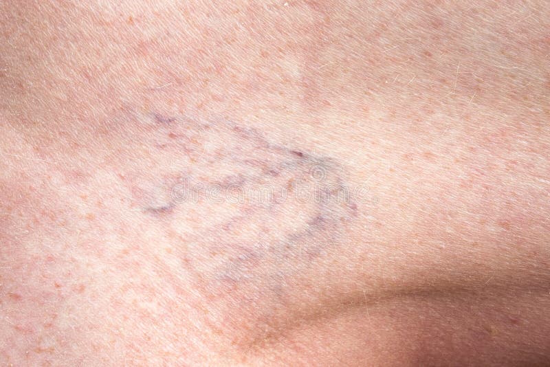 Couperosis stock photo. Image of papules, vessels, skin - 30517826