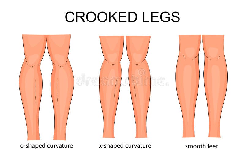 Courbure des jambes illustration de vecteur. Illustration du orthopédie ...