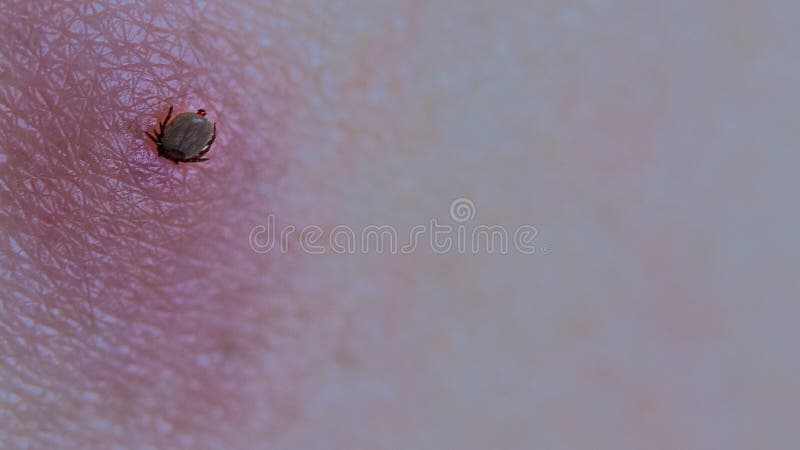 Coutil Infectieux - Ricinus D'Ixodes Photo stock - Image du haricot ...