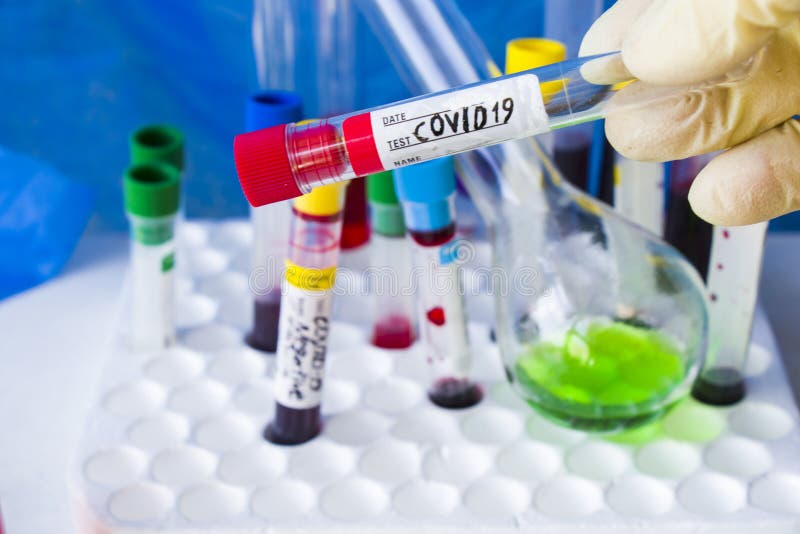 Covid - 19 and Corona Virus Blood Test, Negative and Positive Tests in ...