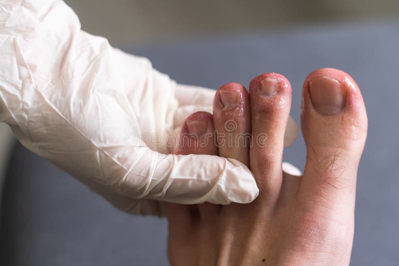 Covid Toes, Bites on a Man S Toes. Stock Image - Image of fear, human ...