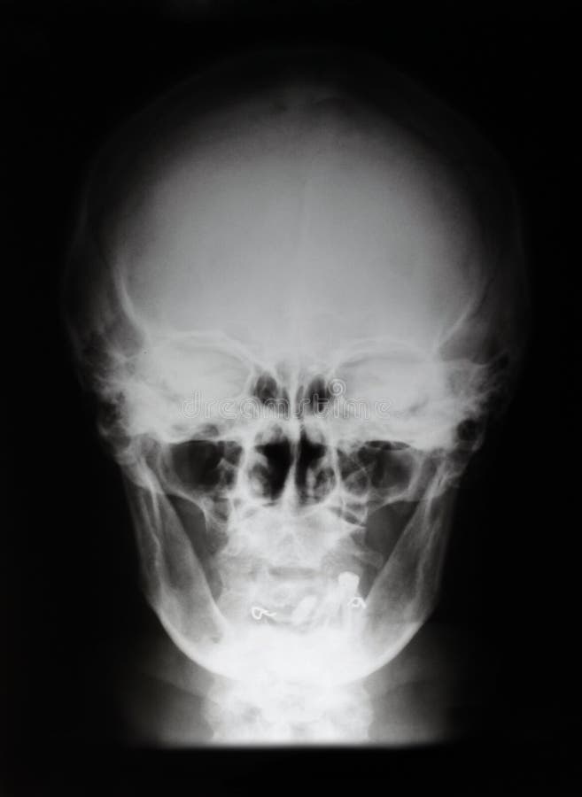 Crânio do raio X foto de stock. Imagem de tomografia - 14491324
