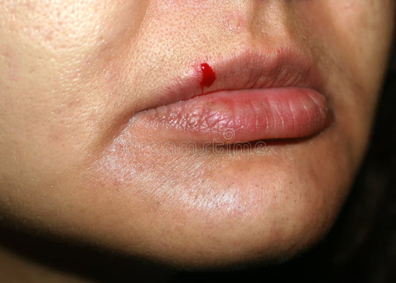Crack on the Lip. Blood on the Upper Lip Stock Image - Image of details ...