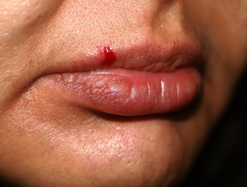 Crack on the Lip. Blood on the Upper Lip Stock Image - Image of ...