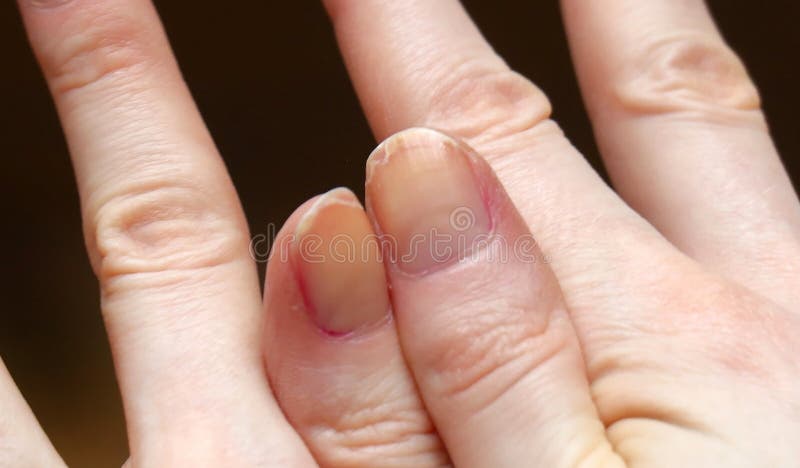 Dry Skin Brittle Nails