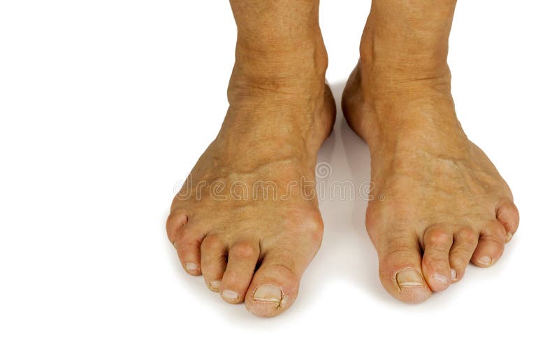 Xray of bunions stock photo. Image of ache, health, bunion - 4862118