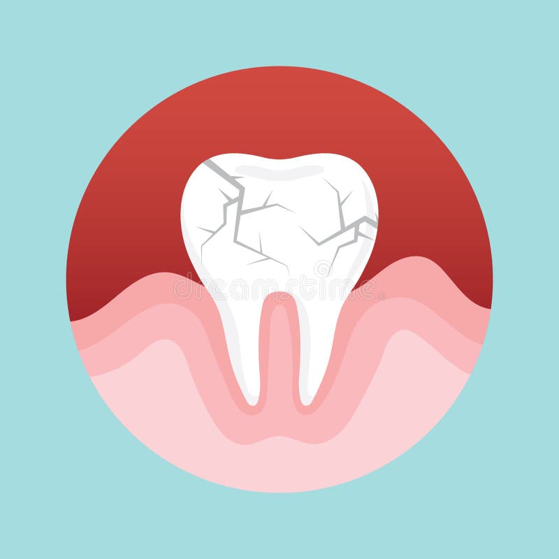 Cracked Tooth. Vector Illustration Decorative Design Stock Vector ...