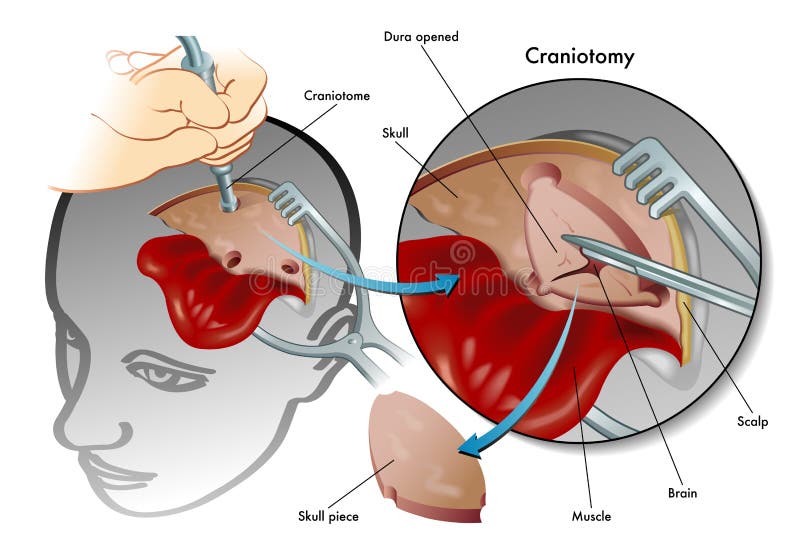 Craniotomy Stock Illustrations – 84 Craniotomy Stock Illustrations ...