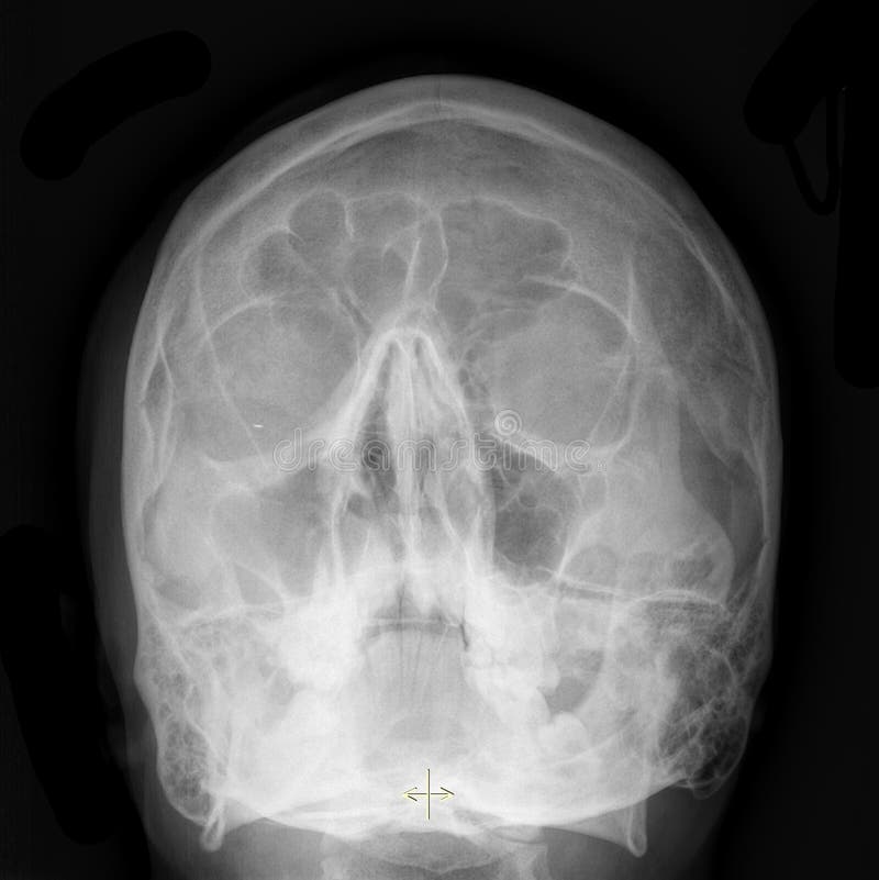 3,788 Cranium Stock Photos - Free & Royalty-Free Stock Photos from ...