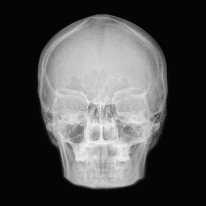 Cranium stock image. Image of diagnostic, roentgen, black - 65514379