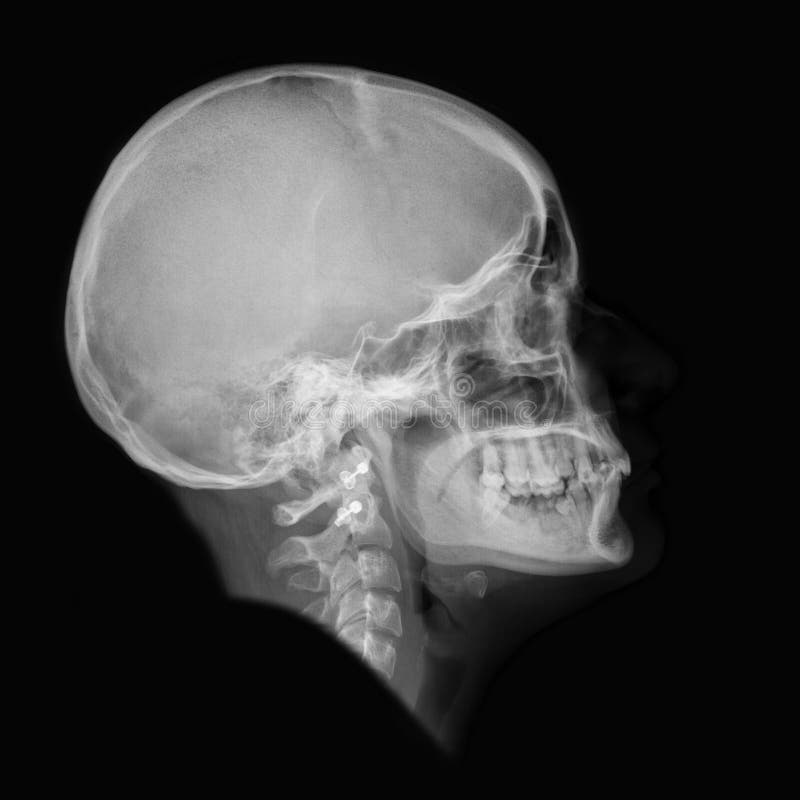 Cranium stock image. Image of diagnostic, roentgen, black - 65514379