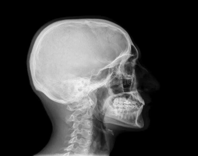 Cranium stock image. Image of frontal, profile, human - 67806787