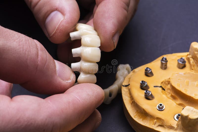 Temporary crown for tooth stock image. Image of cavity - 13823961