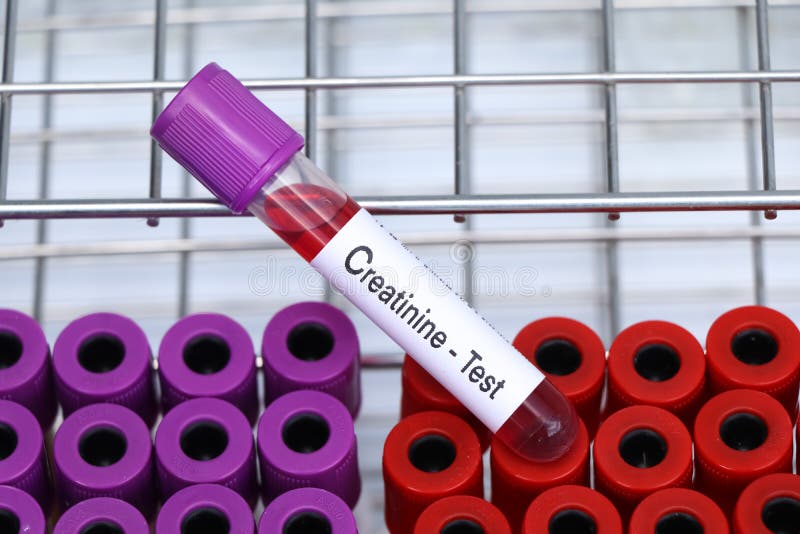 Creatinine Test To Look for Abnormalities from Blood, Blood Sample To ...