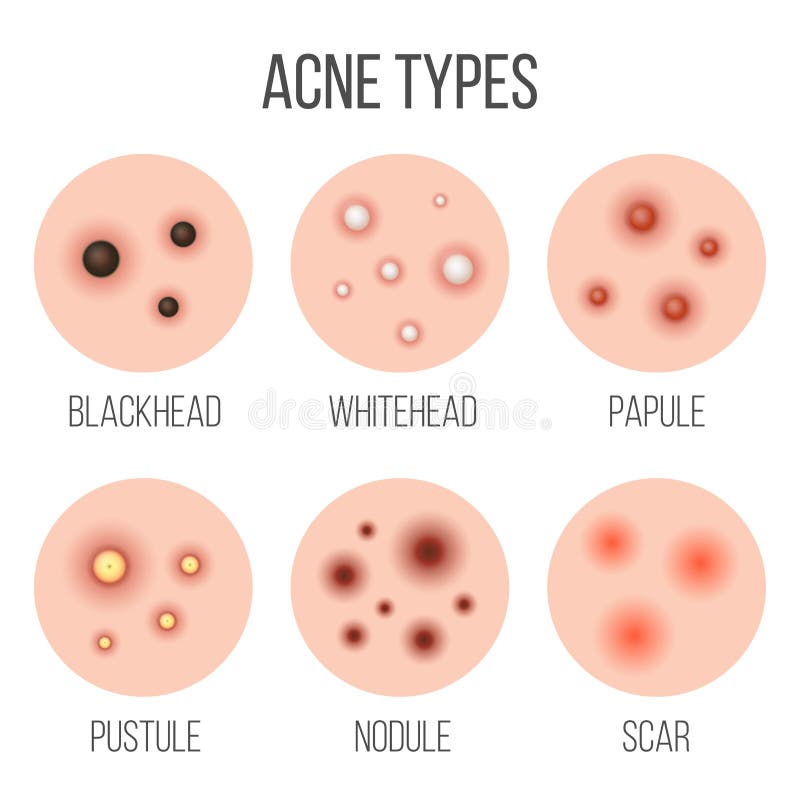 Acne Vulgaris Vector Design Stock Vector Illustration Of