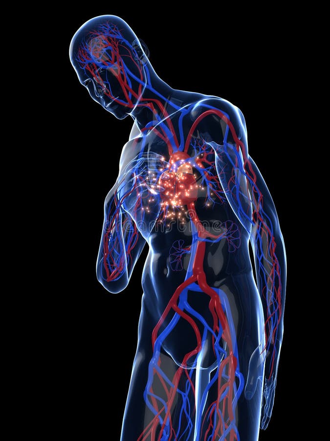 Crise cardiaque illustration stock. Illustration du illustration - 8857597