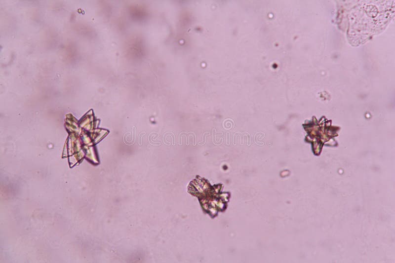 Cristalli, Globuli Rossi E Leucociti Dell'urina Al Microscopio Malattia ...