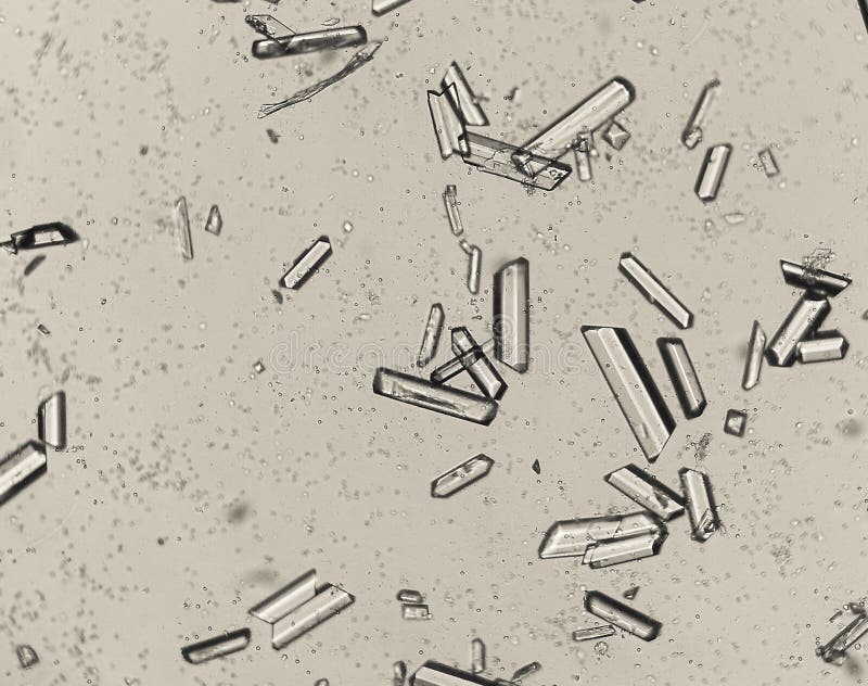 Triple Phosphate Crystals