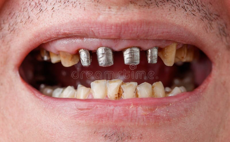 Crooked Metal Teeth in the Mouth. Close-up Stock Photo - Image of ...