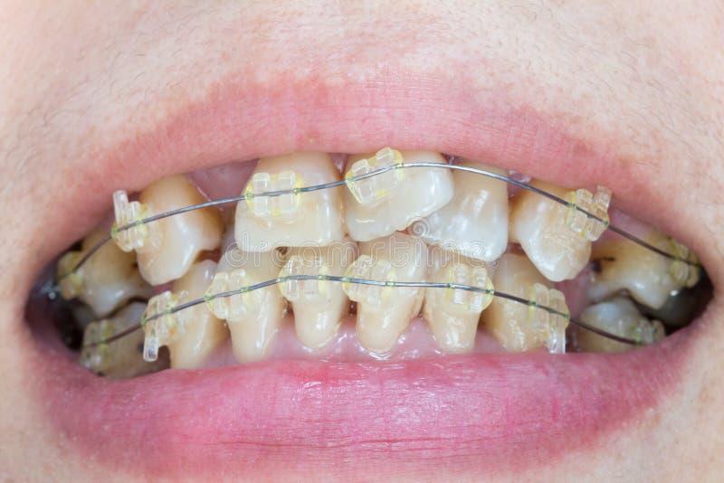 Crooked teeth with braces stock image. Image of hygiene - 52084755