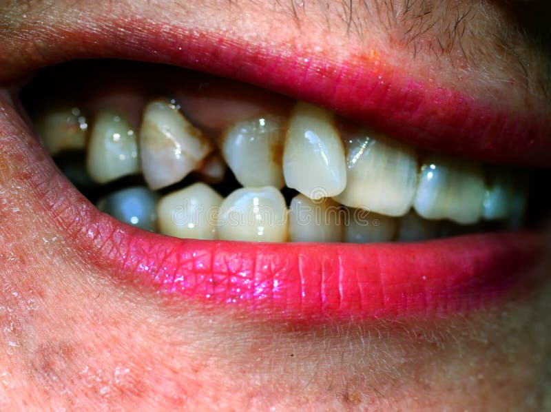 Crooked Teeth in the Mouth. Orthodontics. Malocclusion. Stock Photo ...