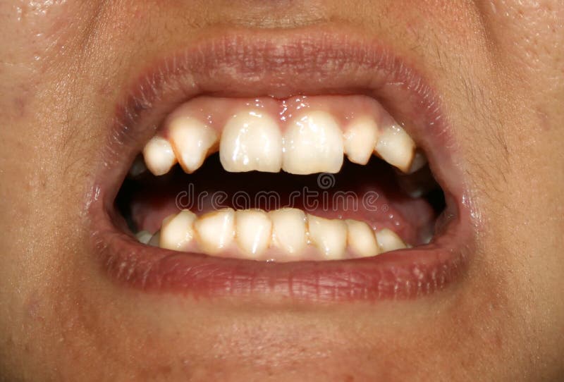 Crooked Teeth. Orthodontics. Underdevelopment and Defects of Teeth ...