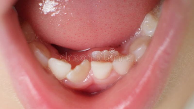Crookedly Growing Teeth To Replace Milk Teeth in a Child. the Second ...
