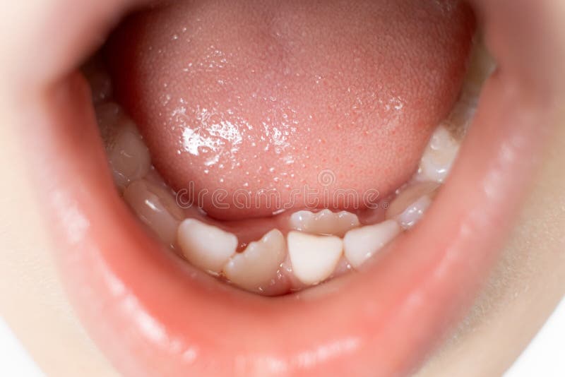 Crookedly Growing Teeth To Replace Milk Teeth in a Child. the Second ...