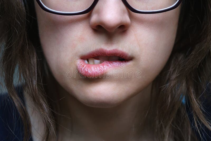 Cropped Image of Womans Face Biting Skin on Dry Chapped Lips Stock ...