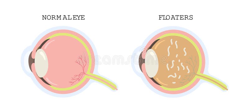 Cross Section Detachment Eye Floater Vector Illustration Stock Vector ...