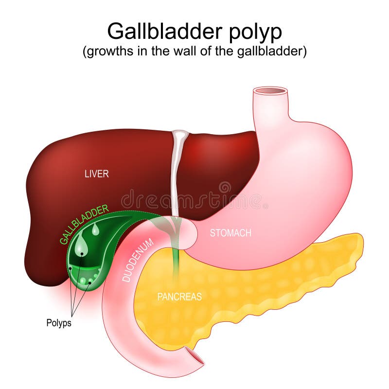 Cross Section of a Gallbladder with Polyps Stock Vector - Illustration ...