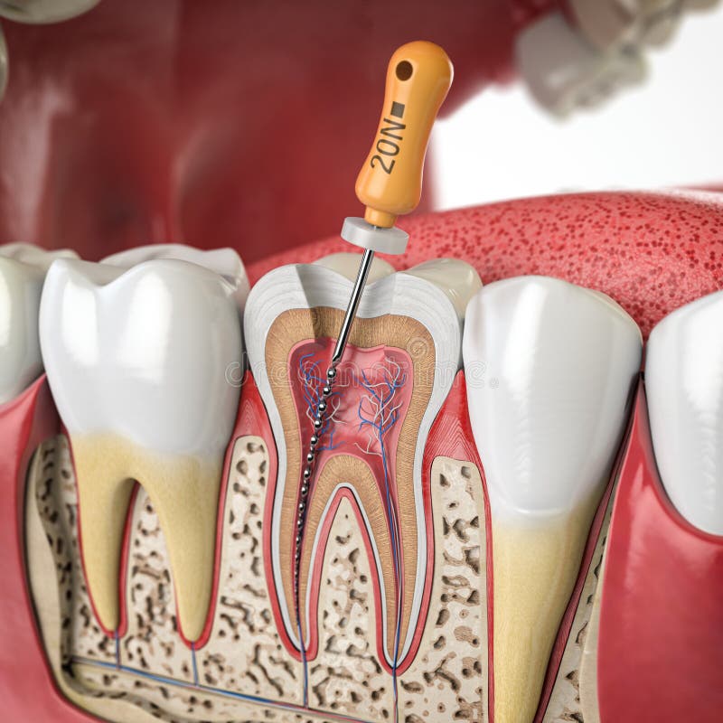 Cross Section of Human Tooth with Endodontic Rotary File Stock ...