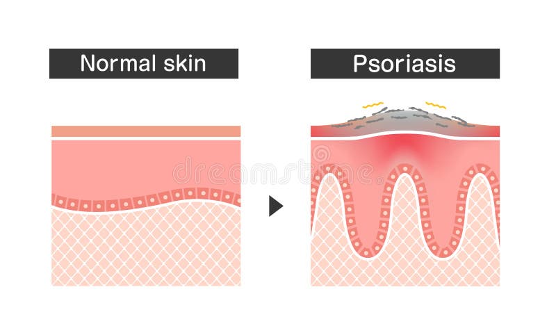Cross Section of Psoriasis Skin / Flat Vector Illustration Stock Vector ...