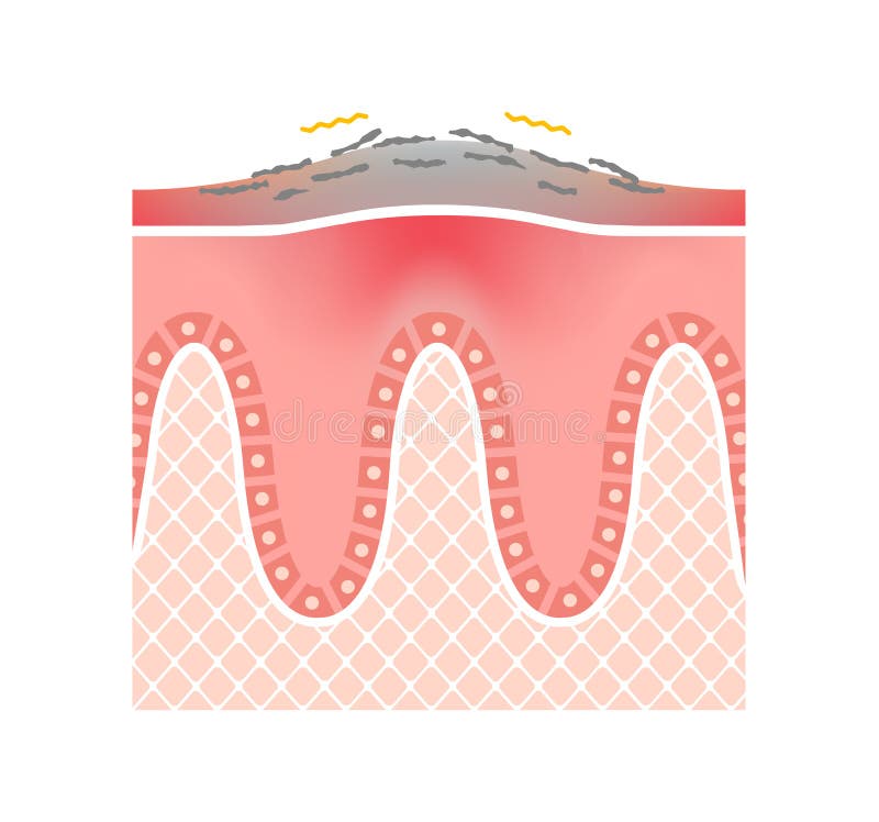 Cross Section of Psoriasis Skin / Flat Vector Illustration Stock Vector ...