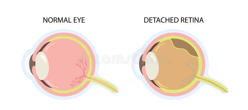 Cross Section Retinal Detachment Eye Vector Illustration Stock Vector ...