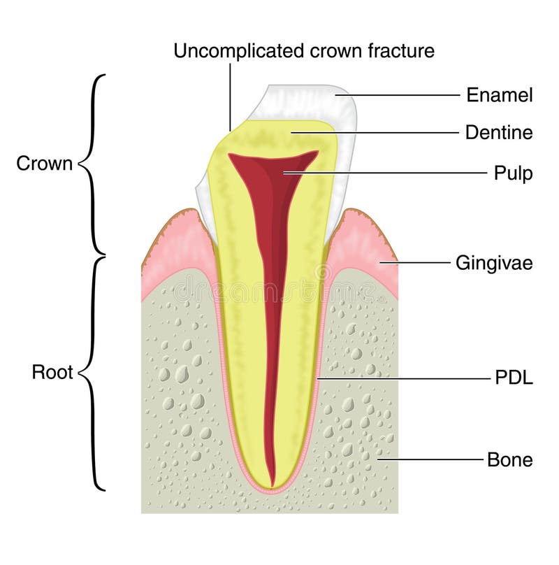 Cross Section of a Tooth with a Crown Frac Stock Vector - Illustration ...