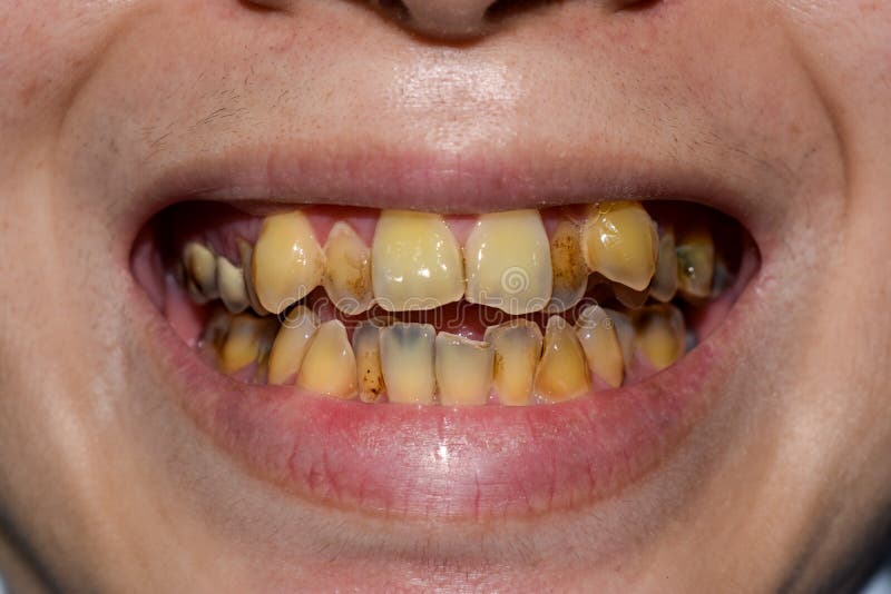 Crowded Front Teeth