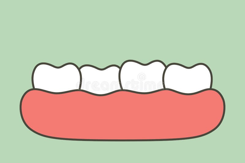 Crowding Teeth Malocclusion Stock Vector - Illustration of overcrowding ...